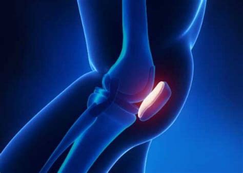 Patellofemoral Realignment Orthopedic Knee Doctor Vail Aspen