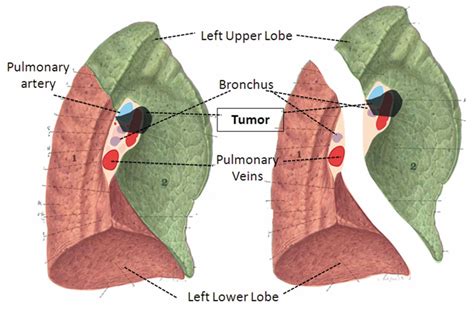 What Is The Lung Parenchyma At Merrill Lavallee Blog
