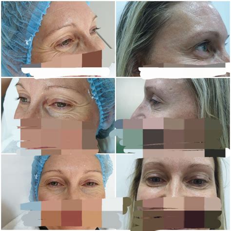 Best Botox In Dubai 2024 Dr Shehzadi Tasneem Sultan