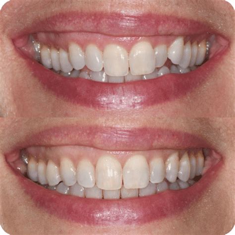 Functional Orthodontics Optimal Jaw Development