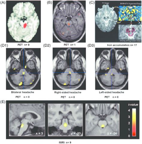 Brainstem Findings Using Functional Imaging In Migraine Figure 2a