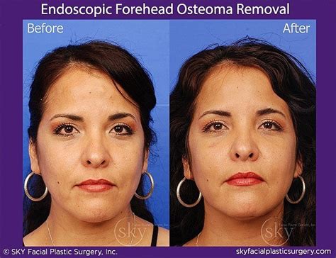 Patient 02 Endoscopic Forehead Osteoma Removal