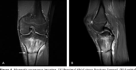 Stress Fracture X Ray Tibia