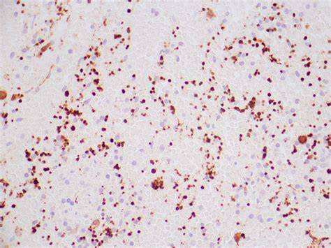 Factor Xiiia Control Dx