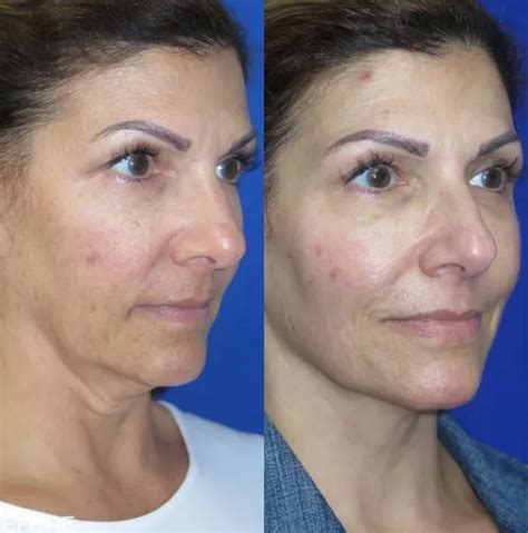 314946 Faceology® Md