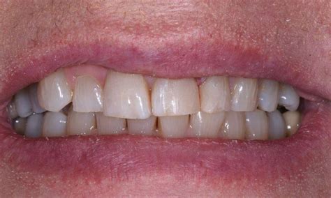 Bonding Of Two Front Teeth Before And After Photos Manchester Nh