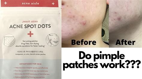 Can You Use Pimple Patches On Open Pimples At Jeffery Leticia Blog