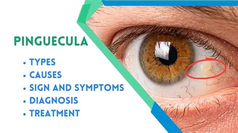 Pinguecula Definition Causes And Management Notes