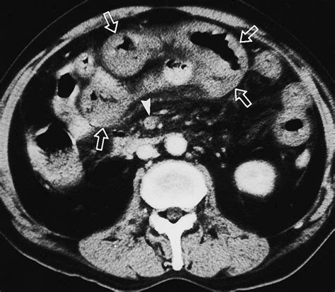 Ct And Mr Imaging Findings Of Bowel Ischemia From Various Primary