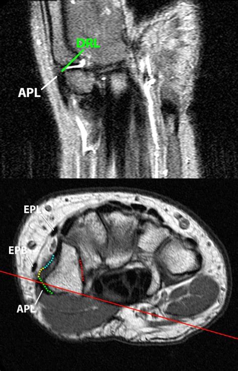 Mri Musculo Skeletal Section Thumb Carpo Metacarpal Joint