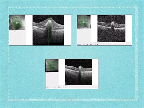 Retinal Artery Macroaneurysm Pptx
