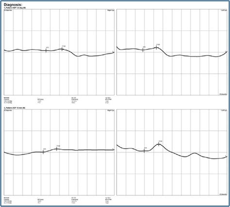 Inferior Temporal Visual Field Defect