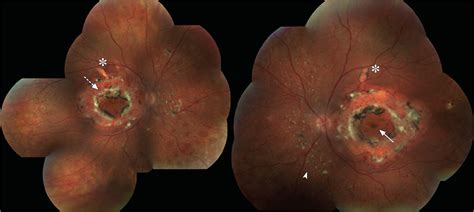 Cone Dystrophy Eye Disorder At Roberta York Blog