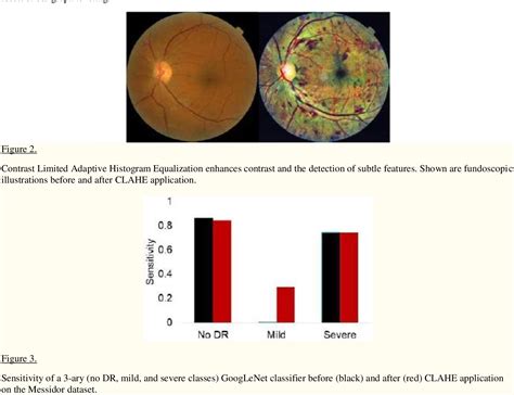 Figure 3 From Diabetic Blindness Detection System Using Convolution Neural Network Semantic