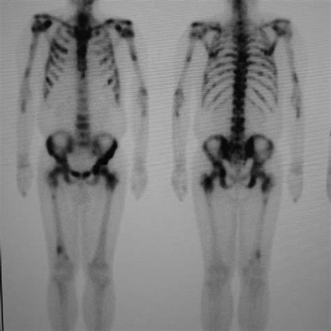 Bone Scintigraphy Findings Bone Scintigraphy Reveals Multiple Bone