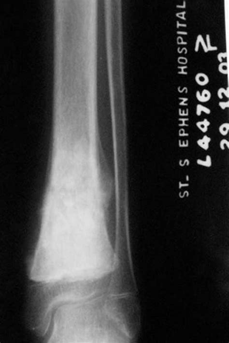 Chondroblastic Osteosarcoma Of The Lower Tibia A Case Report The Foot And Ankle Online Journal