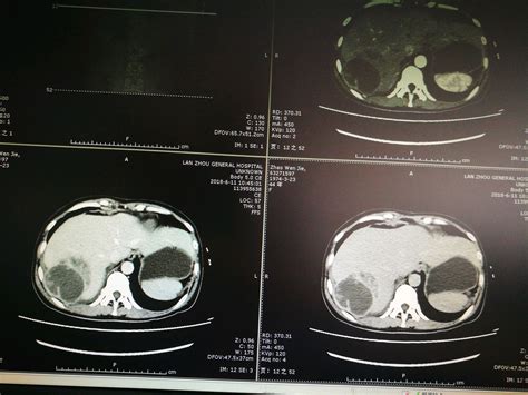 肝脓肿梦是醉新浪博客