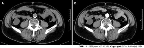 Asymptomatic Low Grade Appendiceal Mucinous Neoplasm A Case Report