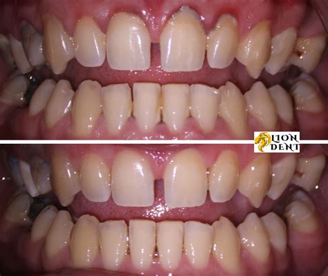 Почистване на зъбен камък и оцветявания с ултразвук плюс полиране с Airflow и обстоен преглед