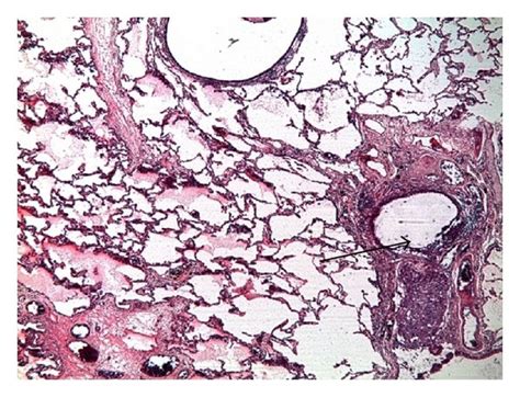 A Linear And Nodular Proliferation Of Neuroendocrine Cells Within