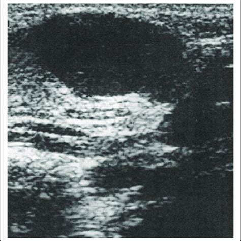 An Oval Non Homogeneous Hypo Echoic Mass Download Scientific Diagram