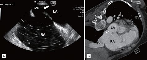Sinus Venosus Asd