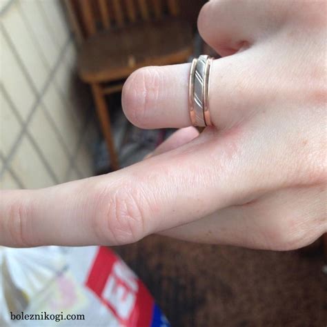 Как у меня появилась экзема после родов