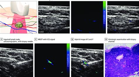 Optoacoustic Guided Fine Needle Biopsy Of Sentinel Lymph Node