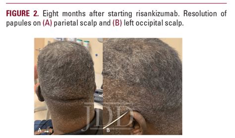 Refractory Dissecting Cellulitis Of The Scalp Treated With Risankizumab