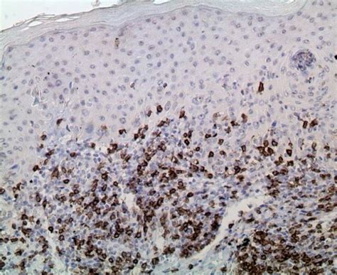 Clinical Images And Histology A Typical Targetoid Lesion On The Right