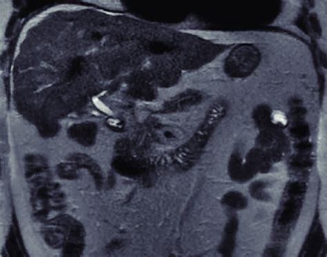 Cirrhotic Liver Morphology Multiple Low Attenuation Foci In The Liver Download Scientific