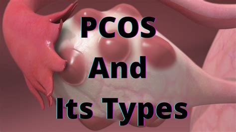PCOS And Its Types A Complete Comprehensive Guide