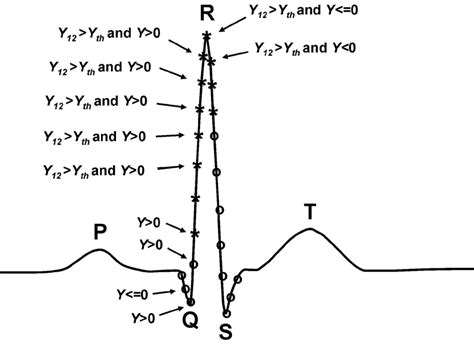 the conditions for detection of r and q wave for r wave detection the
