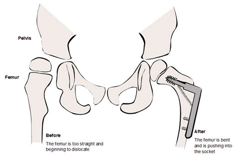 Varising Distal Femoral Osteotomy Lateral Opening Wedge Distal Femoral