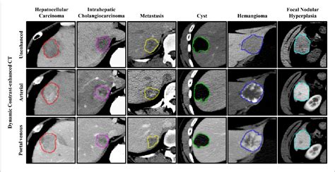 Figure 1 From Automatic Detection And Classification Of Focal Liver Lesions Based On Deep