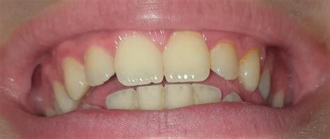 Gingivitis 2 Months After Scaling R Askdentists