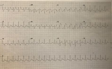 Increasing St Segment Elevations In Leads V1 And V2 New St Segment