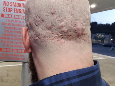 Dissecting Folliculitis 15 Years On Scrolller