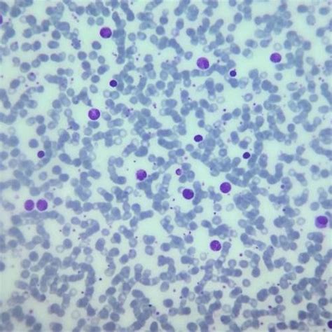 Pdf Hematological Scoring System And Its Significance In Early Diagnosis Of Neonatal Sepsis