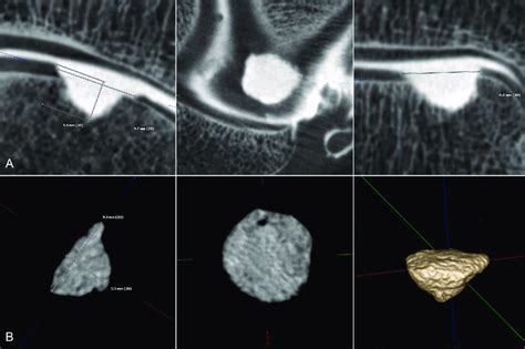 Osteochondral Defect Measurement Example Of Measurements In Flat Panel
