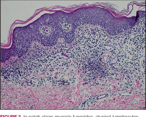 Figure 1 From Annular Erythematous Plaques On The Back Semantic Scholar