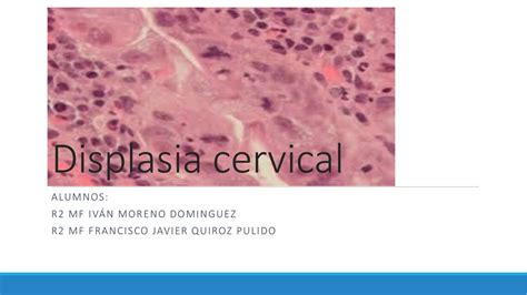 Displasia Cervical Ale Udocz