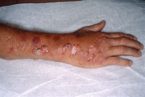 Subcutaneous Nodules In The Forearm From S Apiospermum Infection Download Scientific Diagram
