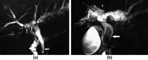 Mri Of Oriental Cholangiohepatitis Clinical Radiology