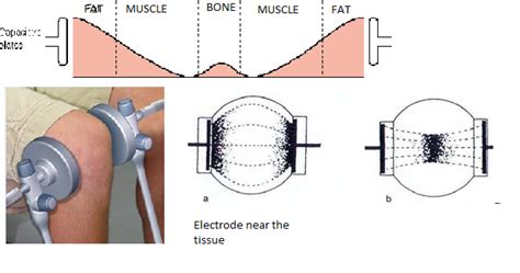 Shortwave Diathermy