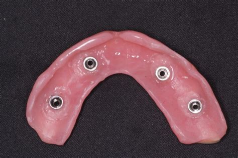Multi Unit Abutments For Denture Conversions This Week In Implants Ddsgadget Community