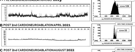 Figure 3 From Carotid Sinus Syndrome Treated By Cardioneuroablation Is Sinus Node Denervation