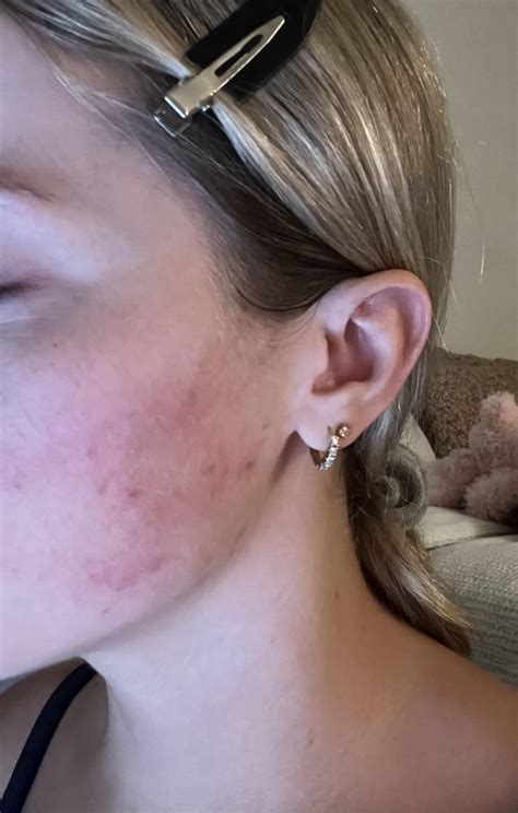 Is This Kp R Keratosis