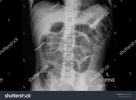 Ileus X Ray