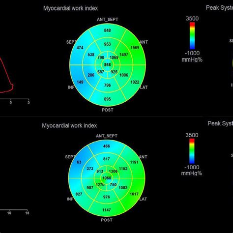 Myocardial Work Analysis Comparison Before A And After B Micra